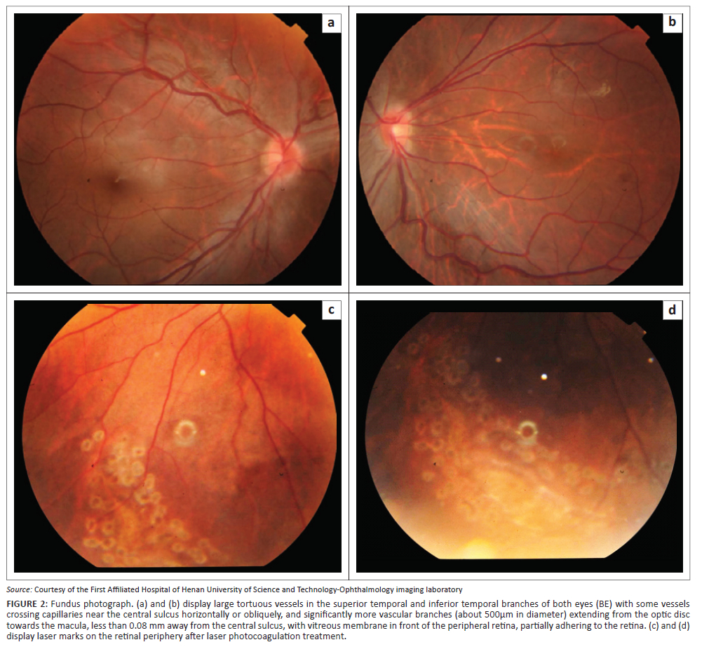 Case of Stickler syndrome in a child without retinal detachment