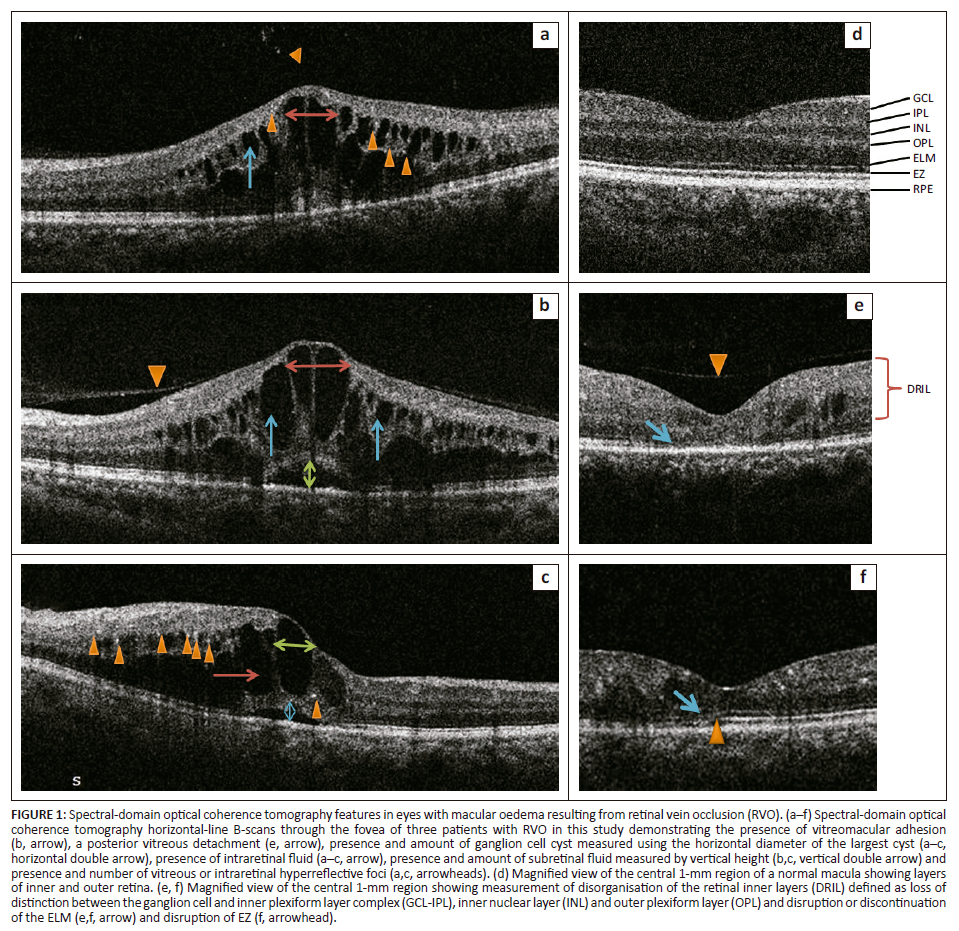 Prognostics optical coherence tomography biomarker in macular oedema ...