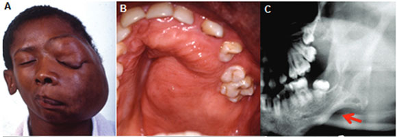 Maxillo-facial radiology case 134