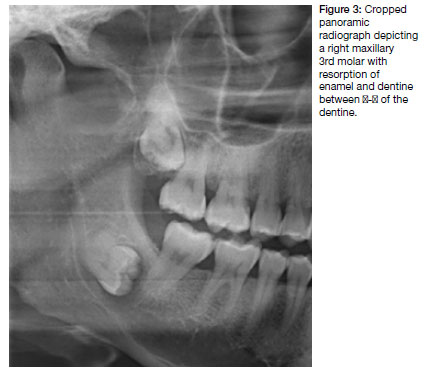 Classification of cases of pre-eruptive intra-coronal resorption