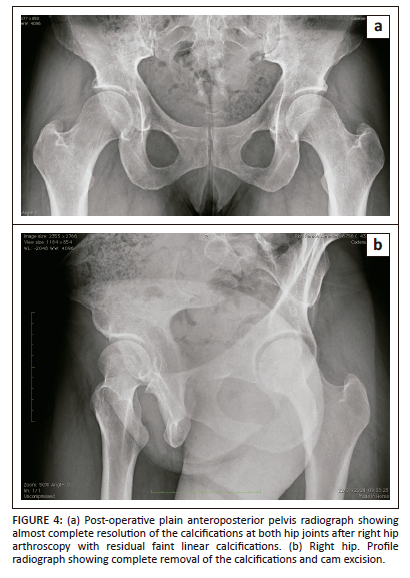Case report and presentation of a new classification system for hip ...
